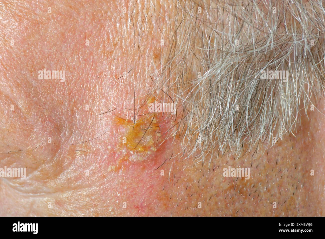 Actinic Keratoses sore 24 hours after a Cryotherapy treatment Stock ...