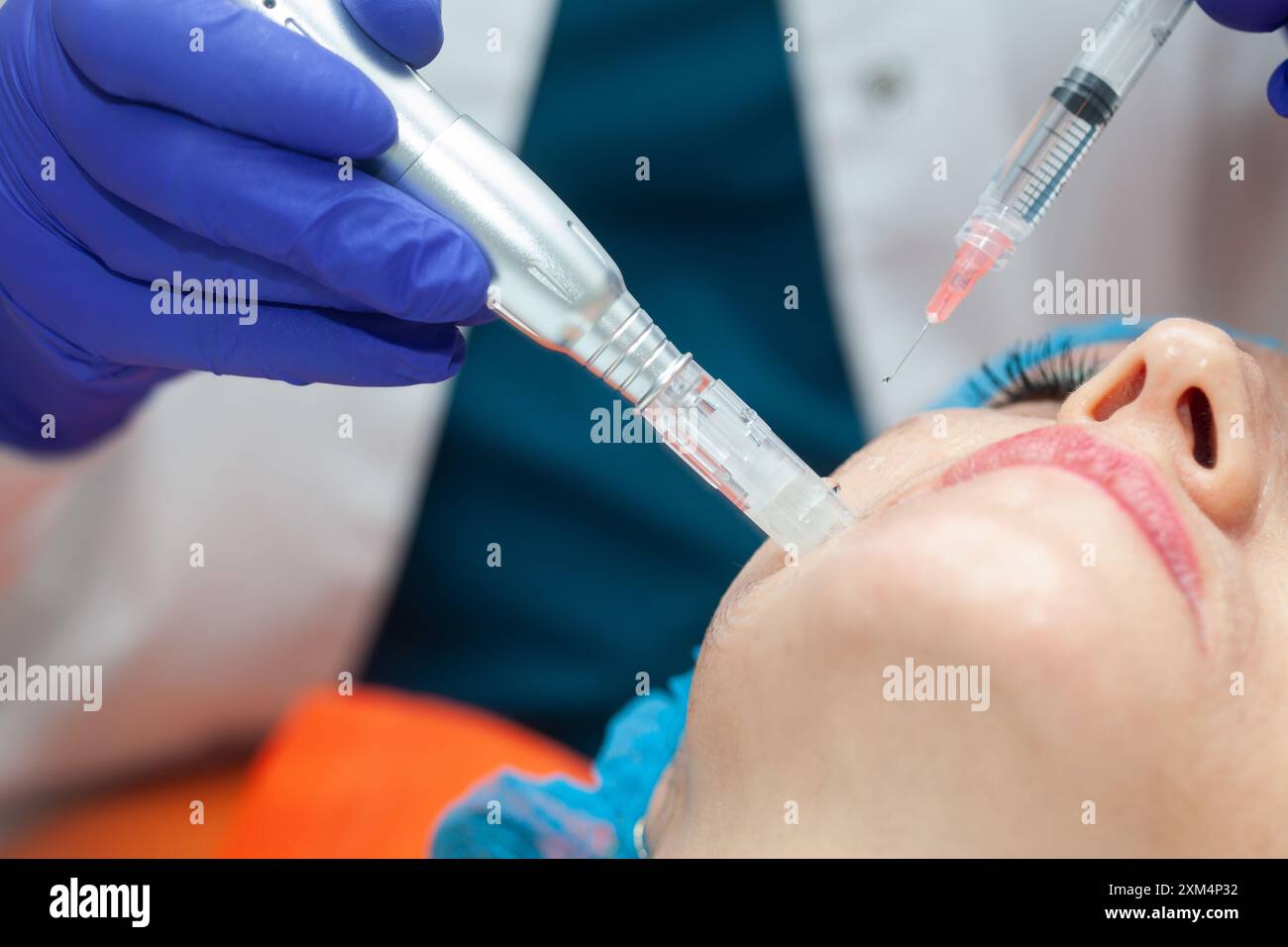 Application of an anti-aging facial rejuvenation cocktail using micro ...