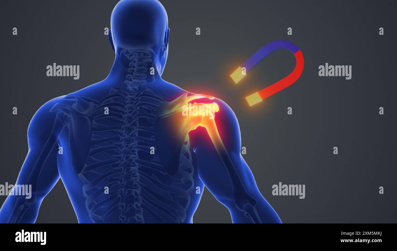 Magnet therapy for shoulder joint pain Stock Photo - Alamy