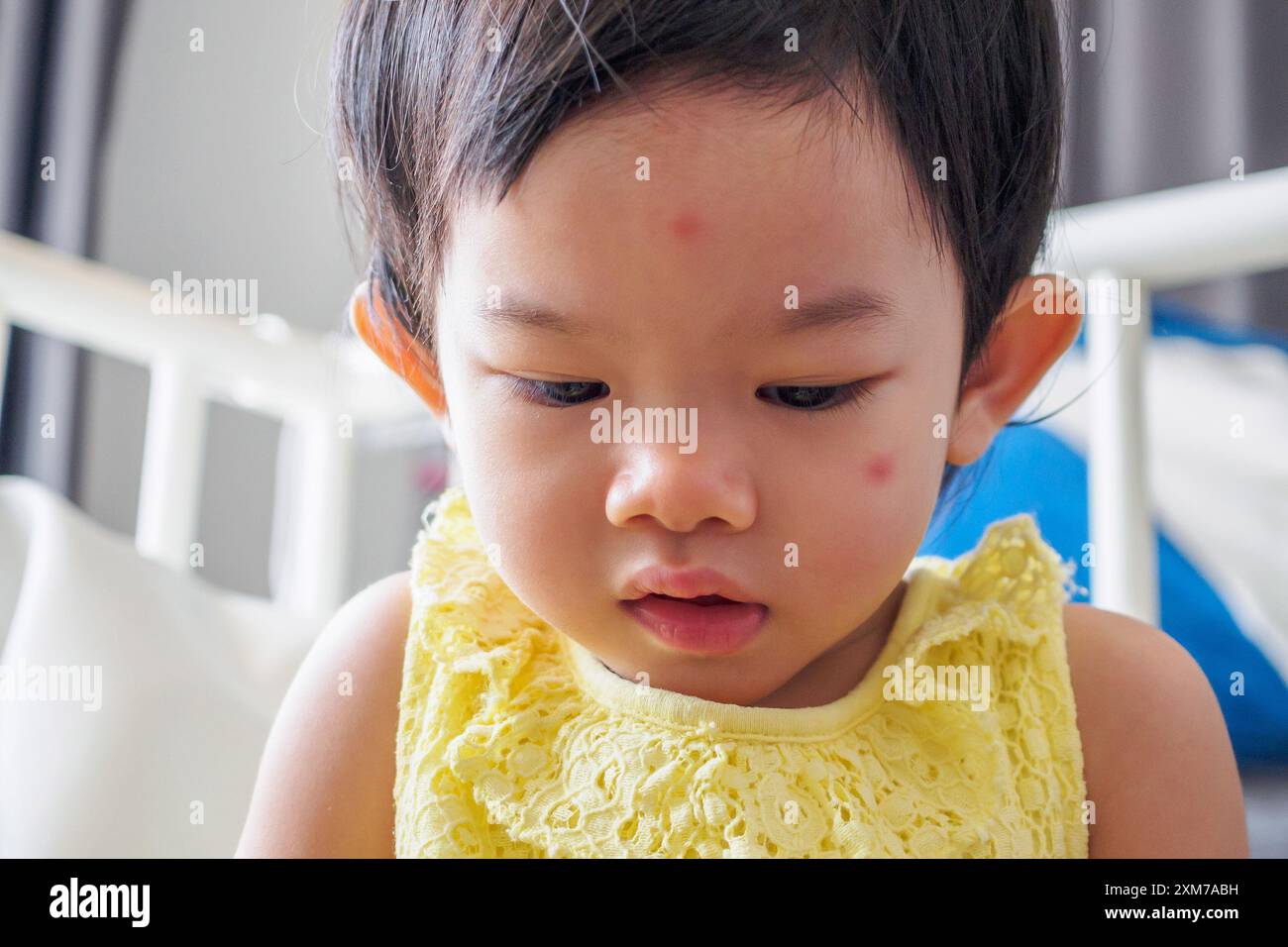 Cute little asian girl with allergy red spot face cause by insect bite ...
