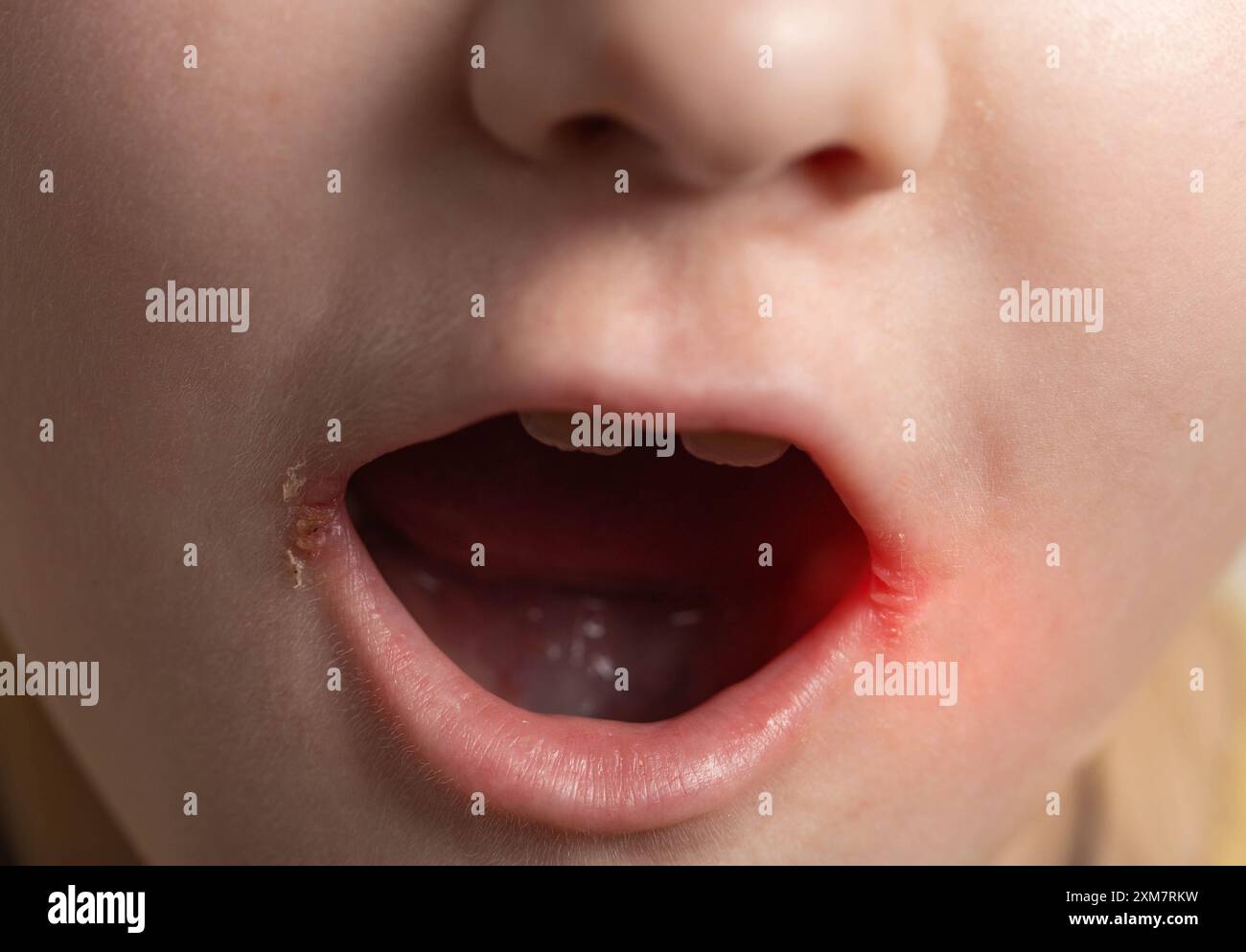Seizures on the corners of the lips of a child s mouth. Bacterial ...