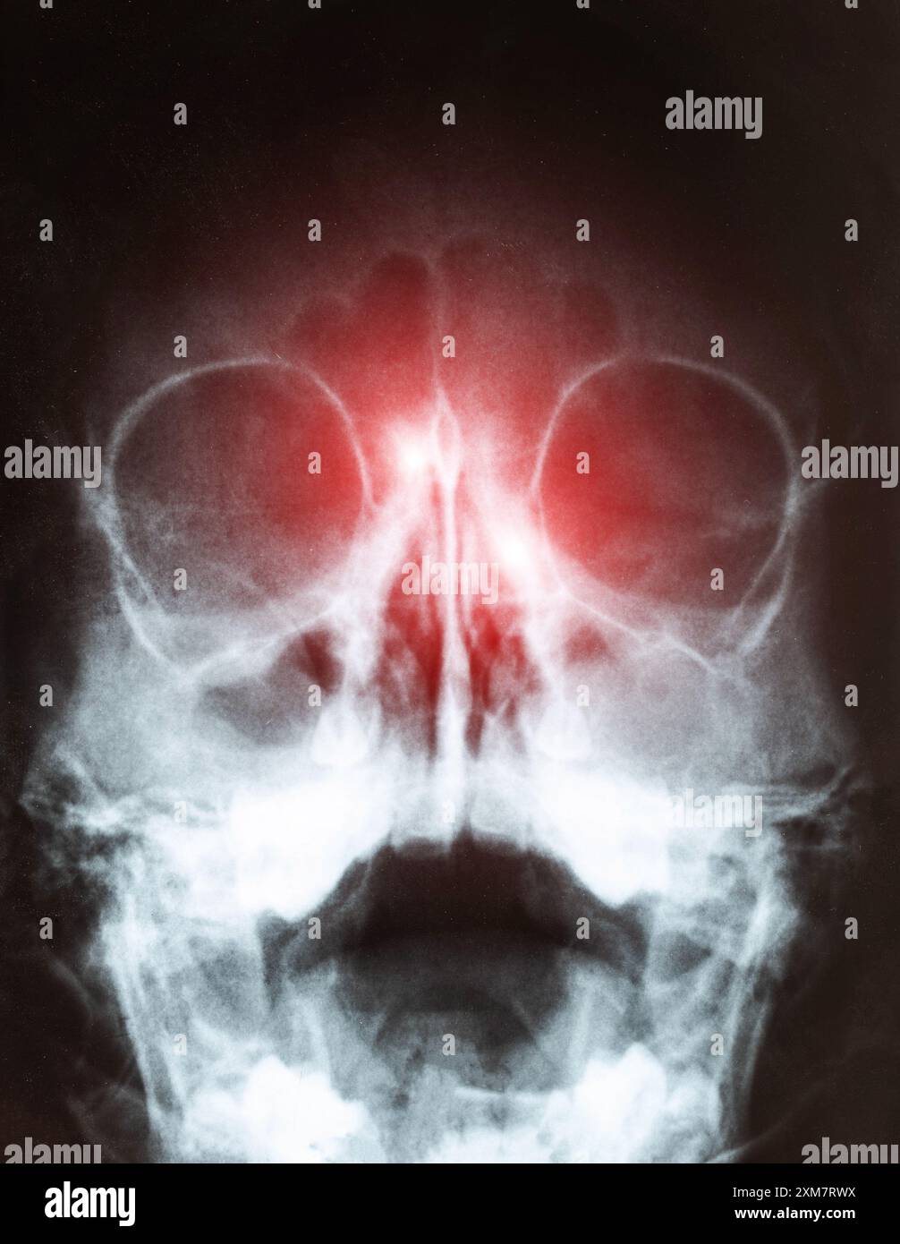 X-ray of sinusitis in a child. Inflammation of the nasal sinuses with ...