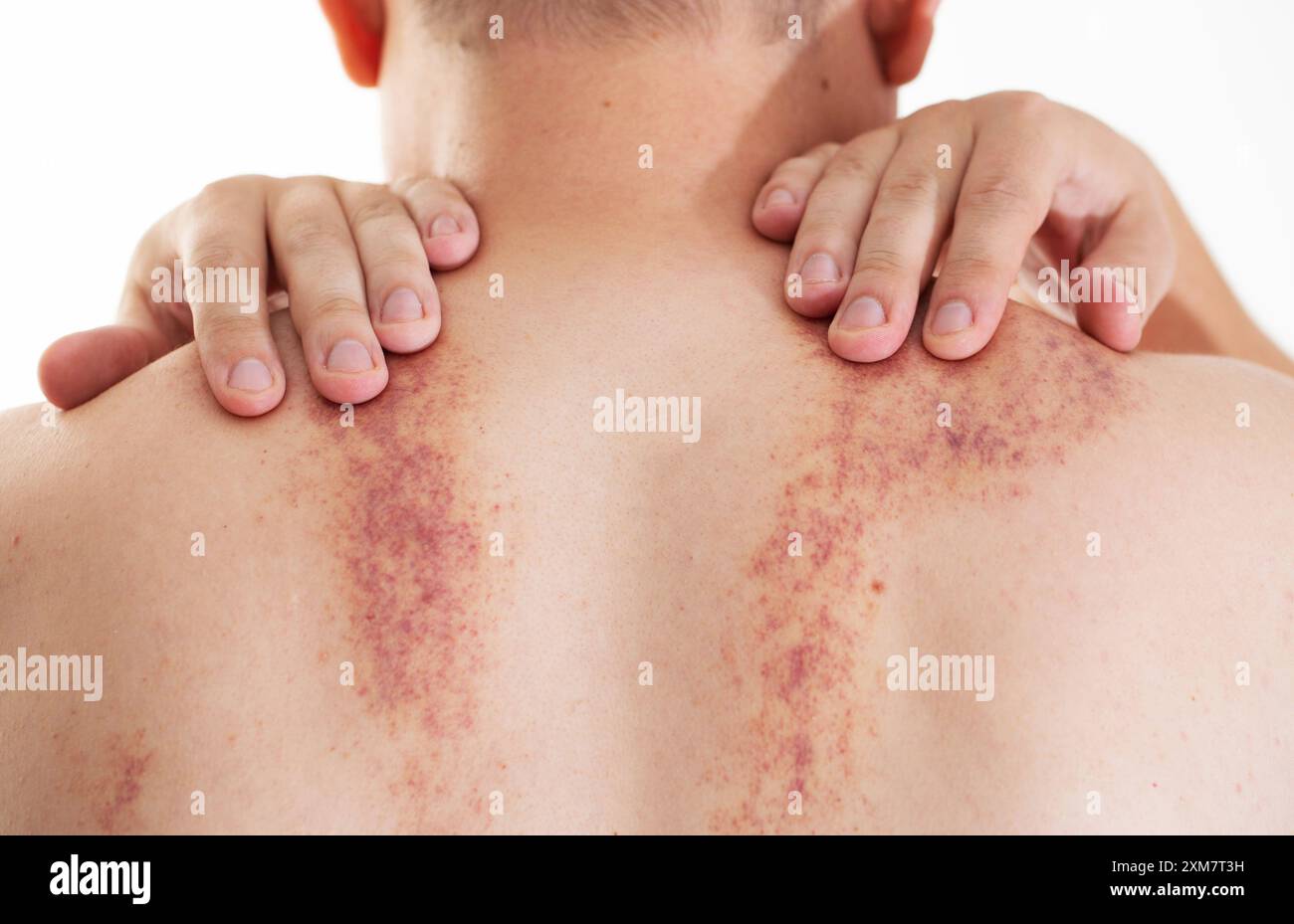 Marks on the skin of a man's back after a massage. Concept of improper ...