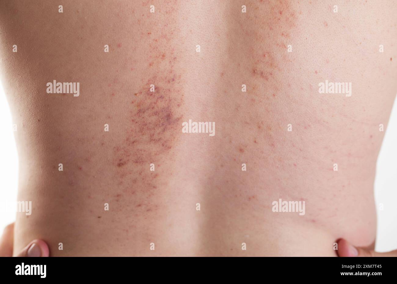 Microhemorrhages hi-res stock photography and images - Alamy