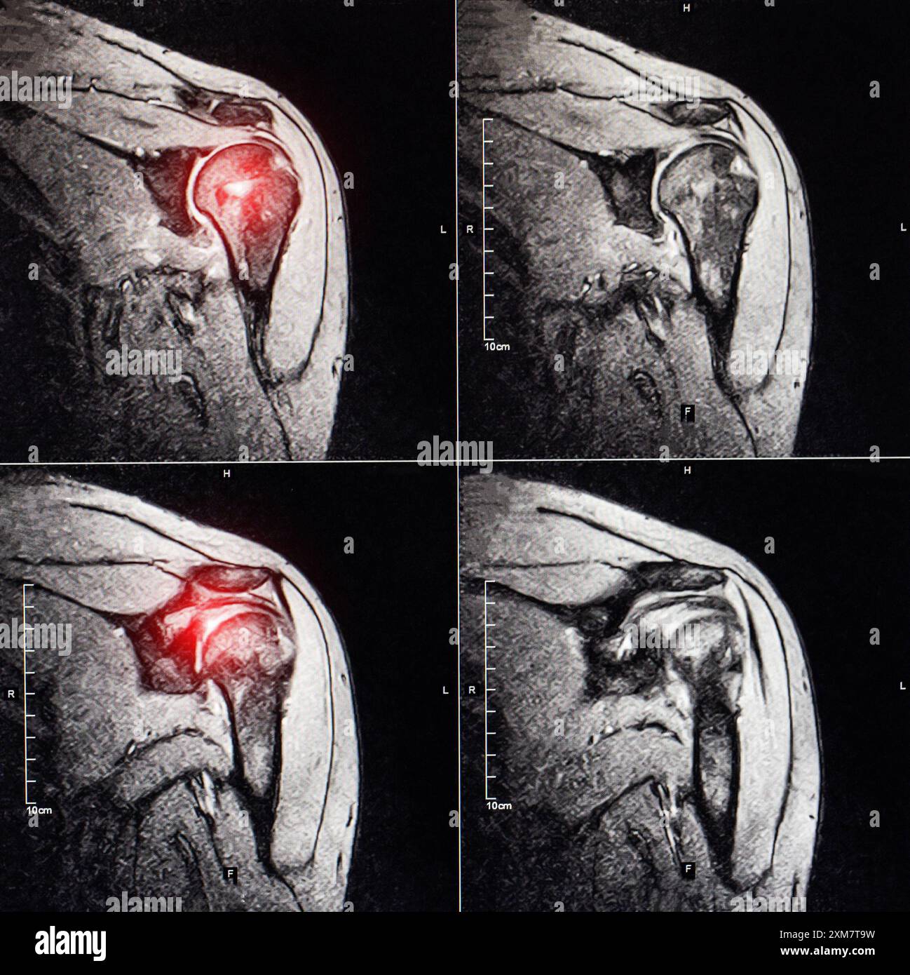 Mri of atrophy hi-res stock photography and images - Alamy
