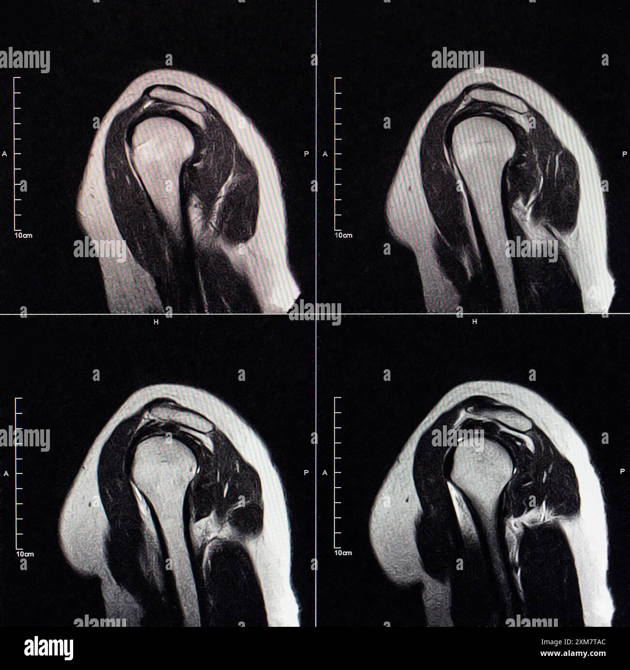 Humeral hi-res stock photography and images - Alamy