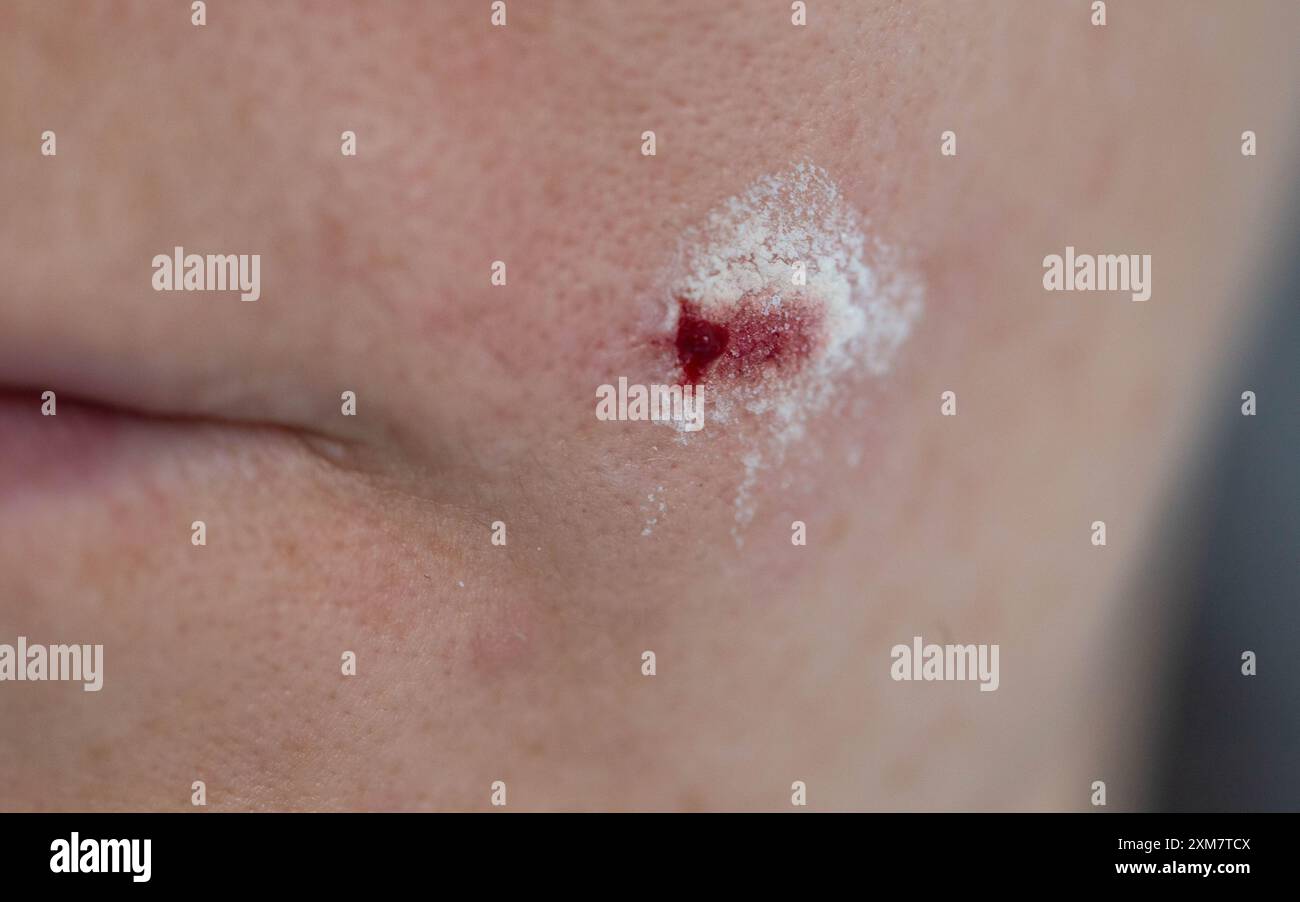 Blood and a wound on a girl s cheek after an injury. Ointments and ...