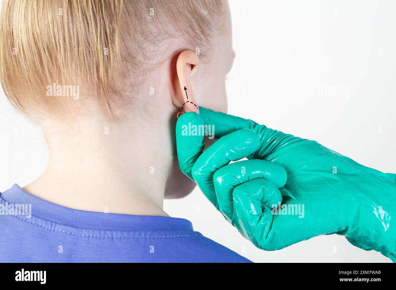 The hand of a plastic surgeon doctor holds the girl's ear on which ...