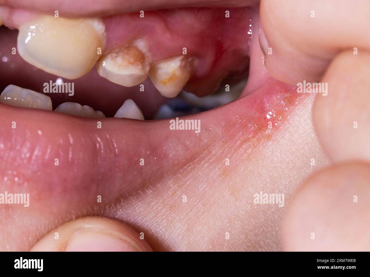 Destruction of enamel on baby teeth in a child, lack of calcium in the ...