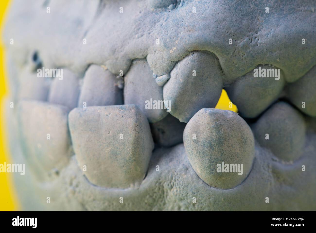Blue plaster impression of the dental jaw of a patient with crooked ...