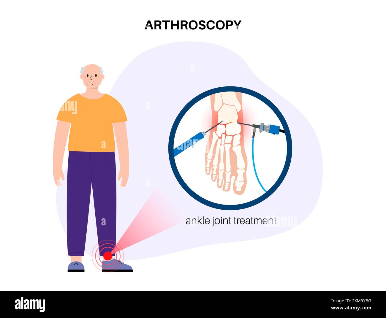 Illustration of an ankle arthroscopy procedure. This is a procedure for ...