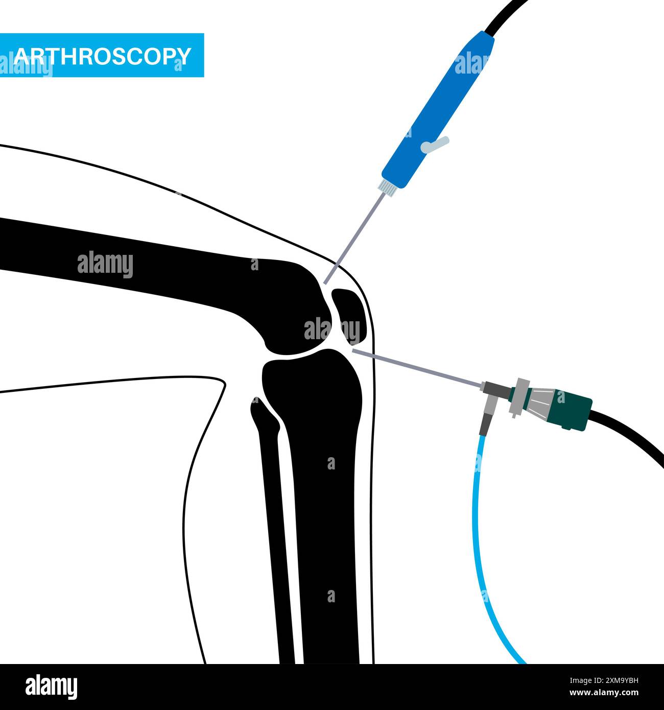 Illustration of knee joint arthroscopy procedure. This is a procedure ...