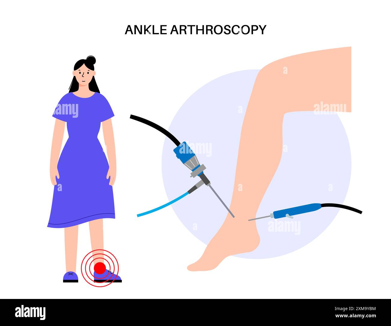 Illustration of an ankle arthroscopy procedure. This is a procedure for ...