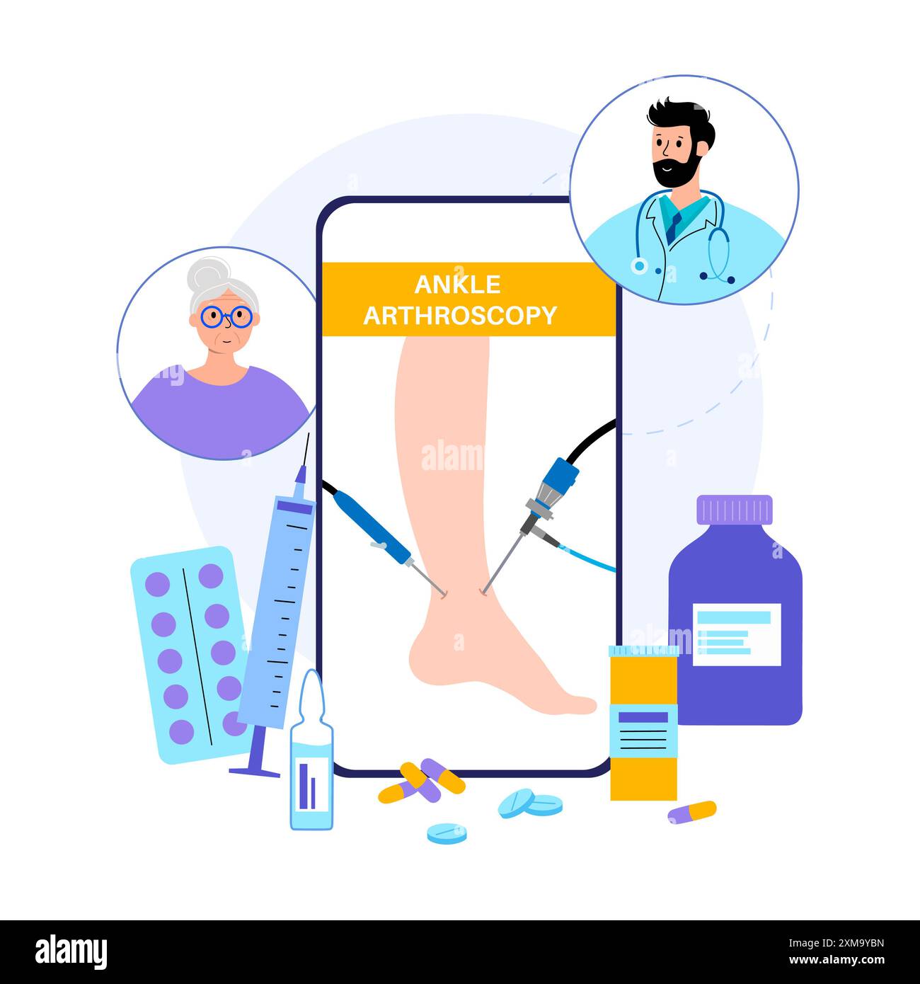 Illustration of an ankle arthroscopy procedure. This is a procedure for ...