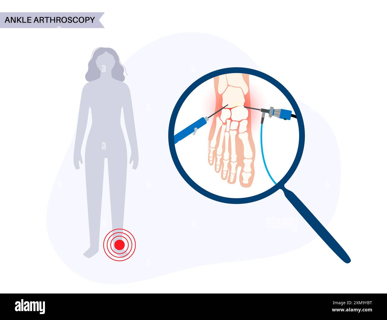 Illustration of an ankle arthroscopy procedure. This is a procedure for ...