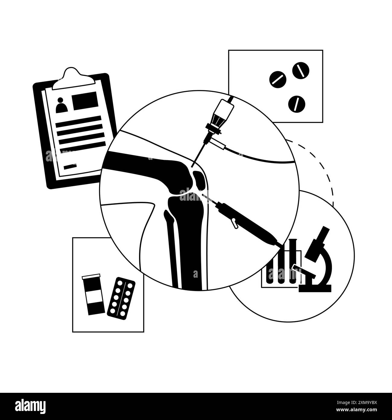 Illustration of knee joint arthroscopy procedure. This is a procedure ...