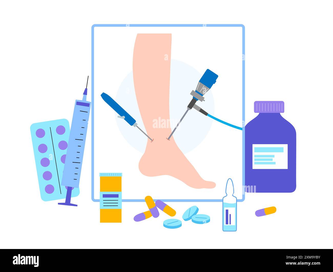 Illustration of an ankle arthroscopy procedure. This is a procedure for ...