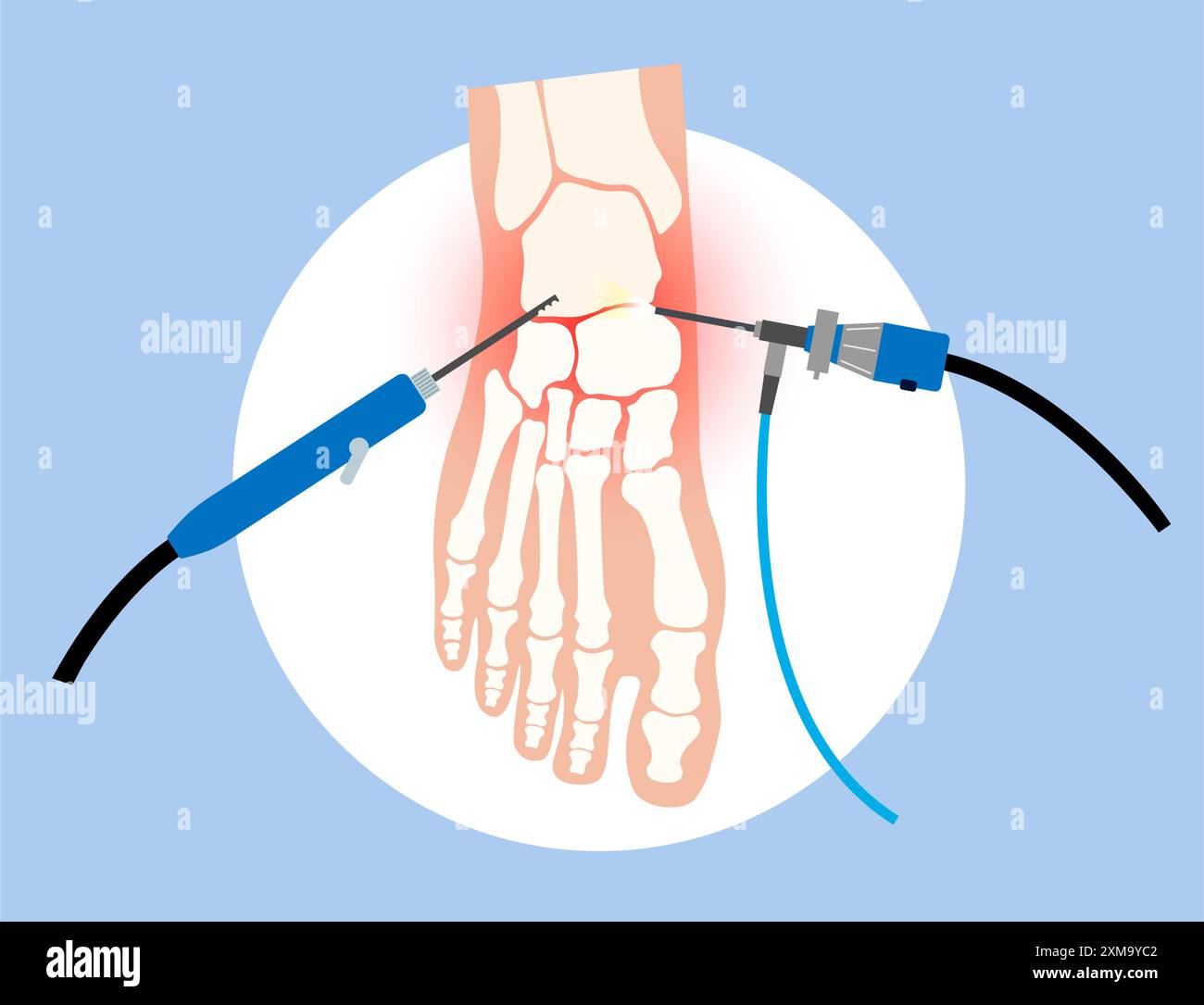 Illustration of an ankle arthroscopy procedure. This is a procedure for ...
