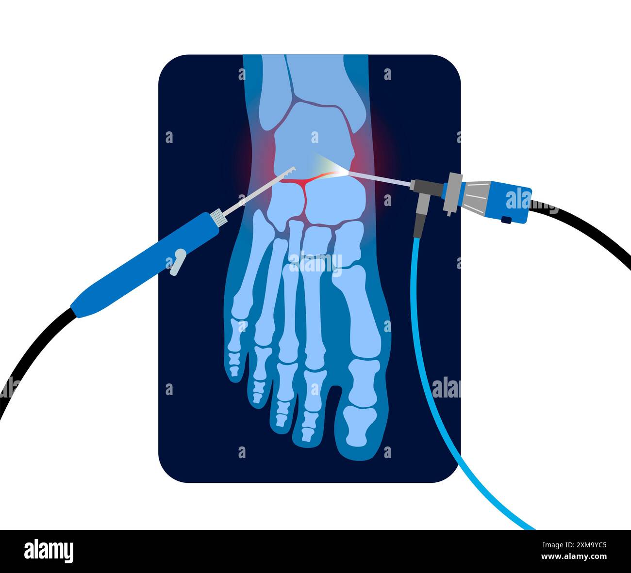 Illustration of an ankle arthroscopy procedure. This is a procedure for ...