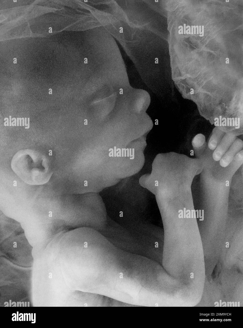 12 weeks fetus hi-res stock photography and images - Alamy