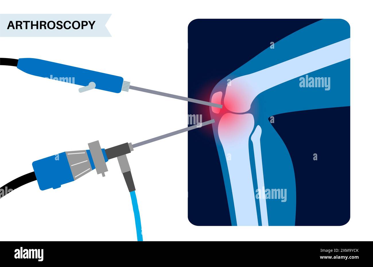 Illustration of knee joint arthroscopy procedure. This is a procedure ...