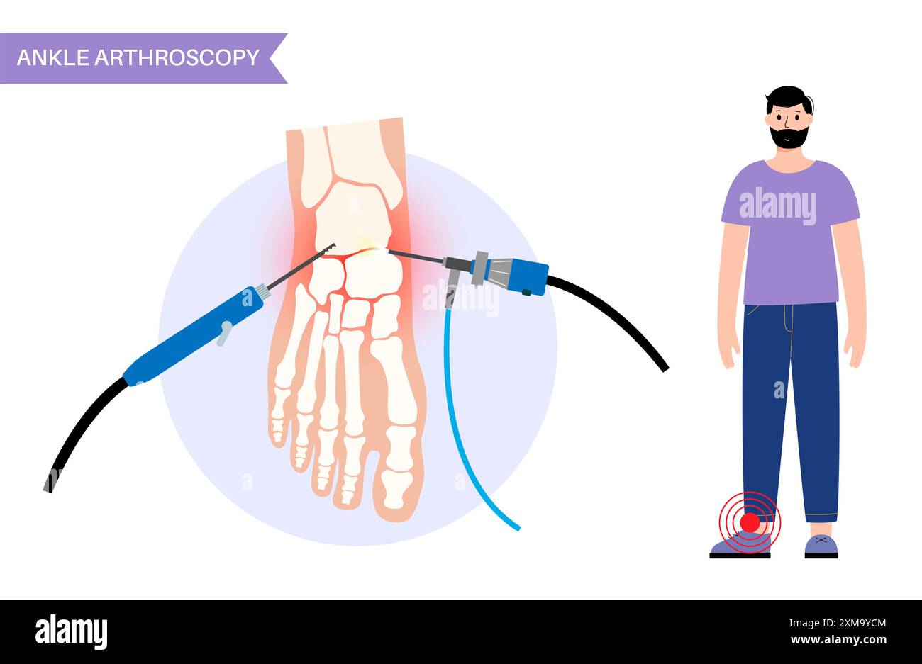 Illustration of an ankle arthroscopy procedure. This is a procedure for ...