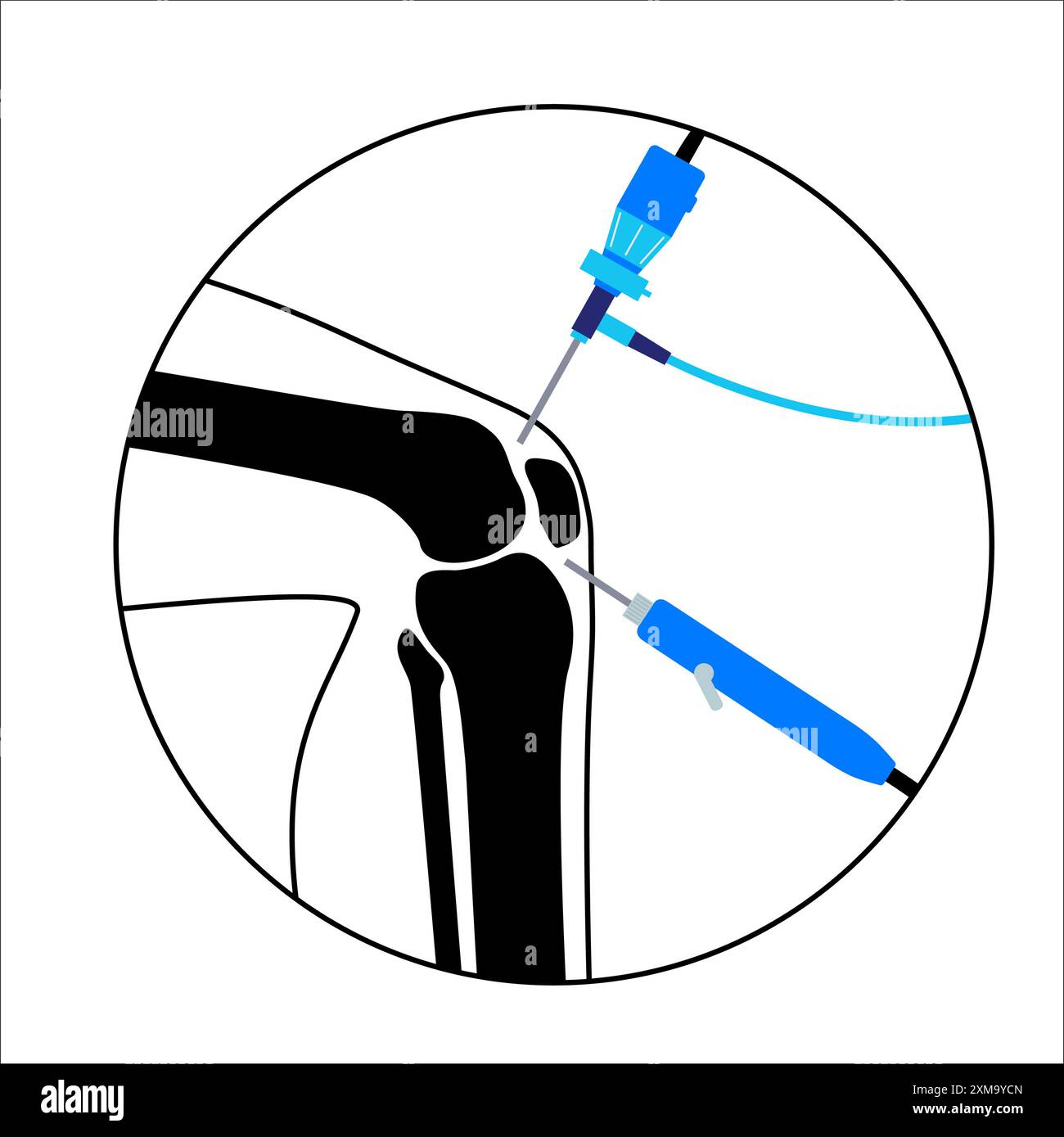 Illustration of knee joint arthroscopy procedure. This is a procedure ...