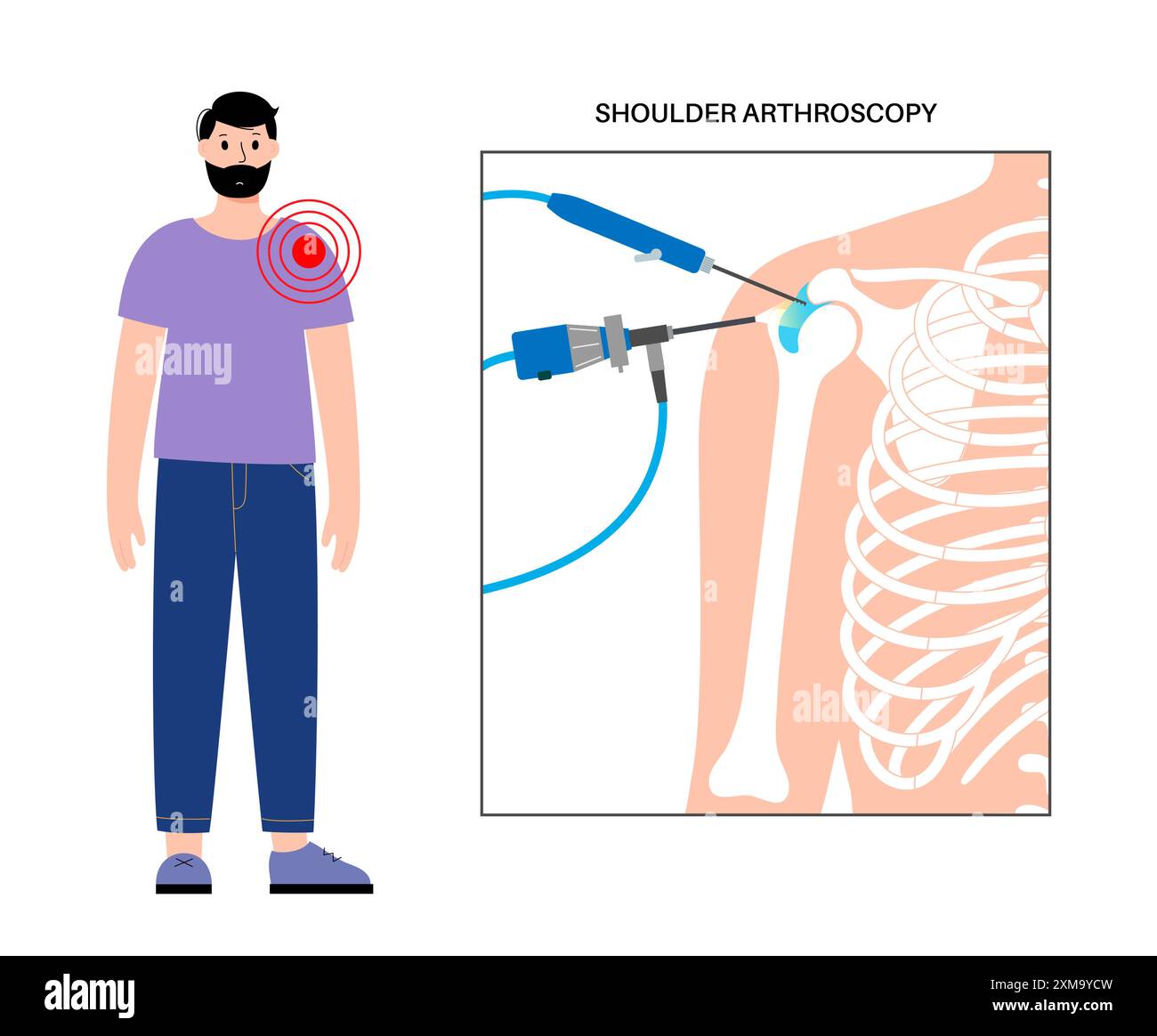 Illustration of a shoulder arthroscopy procedure. This is a procedure ...