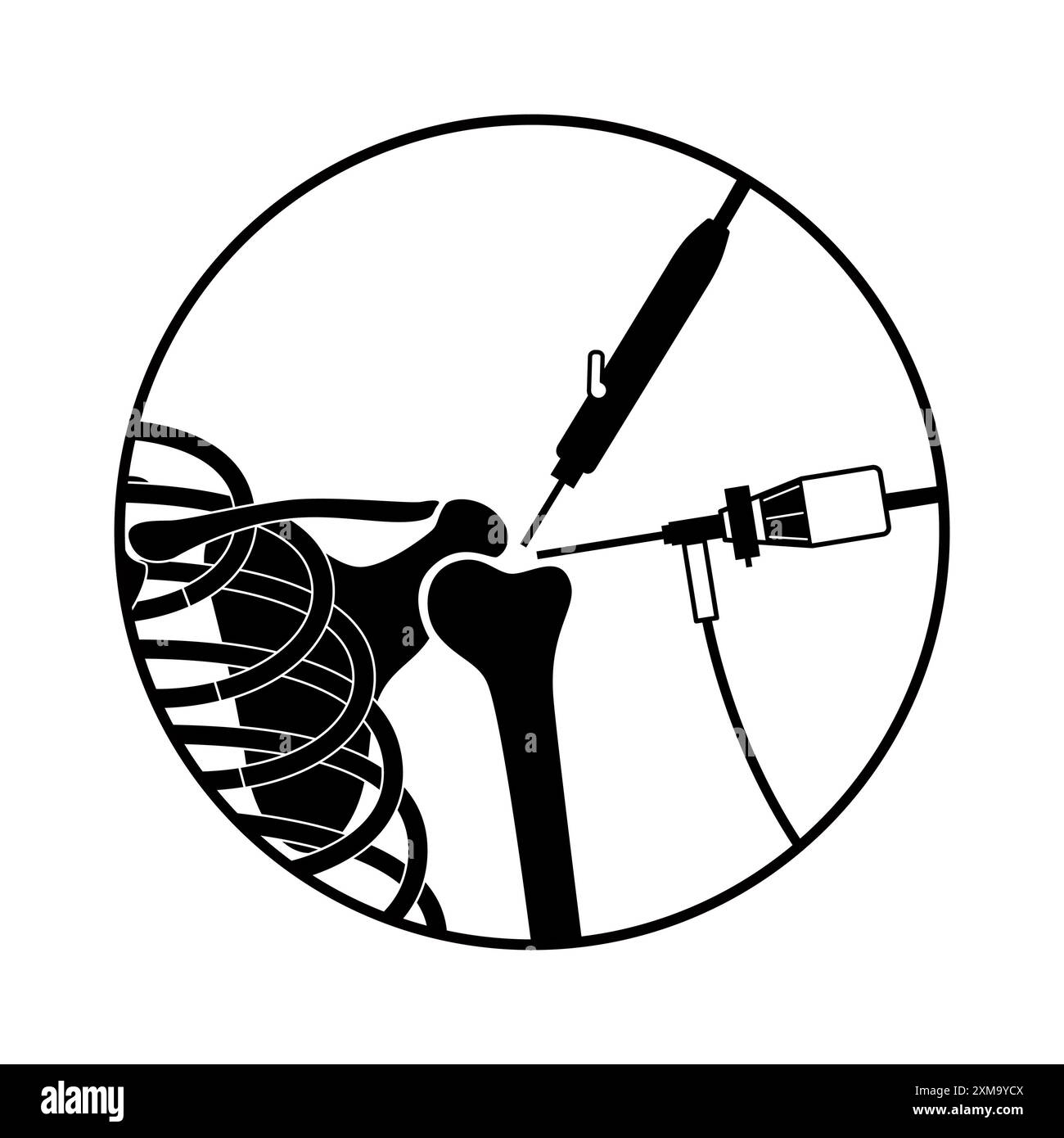 Illustration of a shoulder arthroscopy procedure. This is a procedure ...