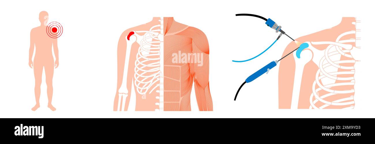 Shoulder arthroscopy procedure hi-res stock photography and images - Alamy