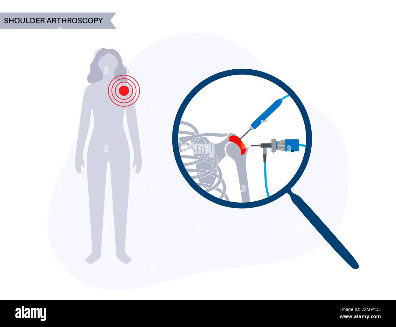 Shoulder arthroscopy procedure hi-res stock photography and images - Alamy