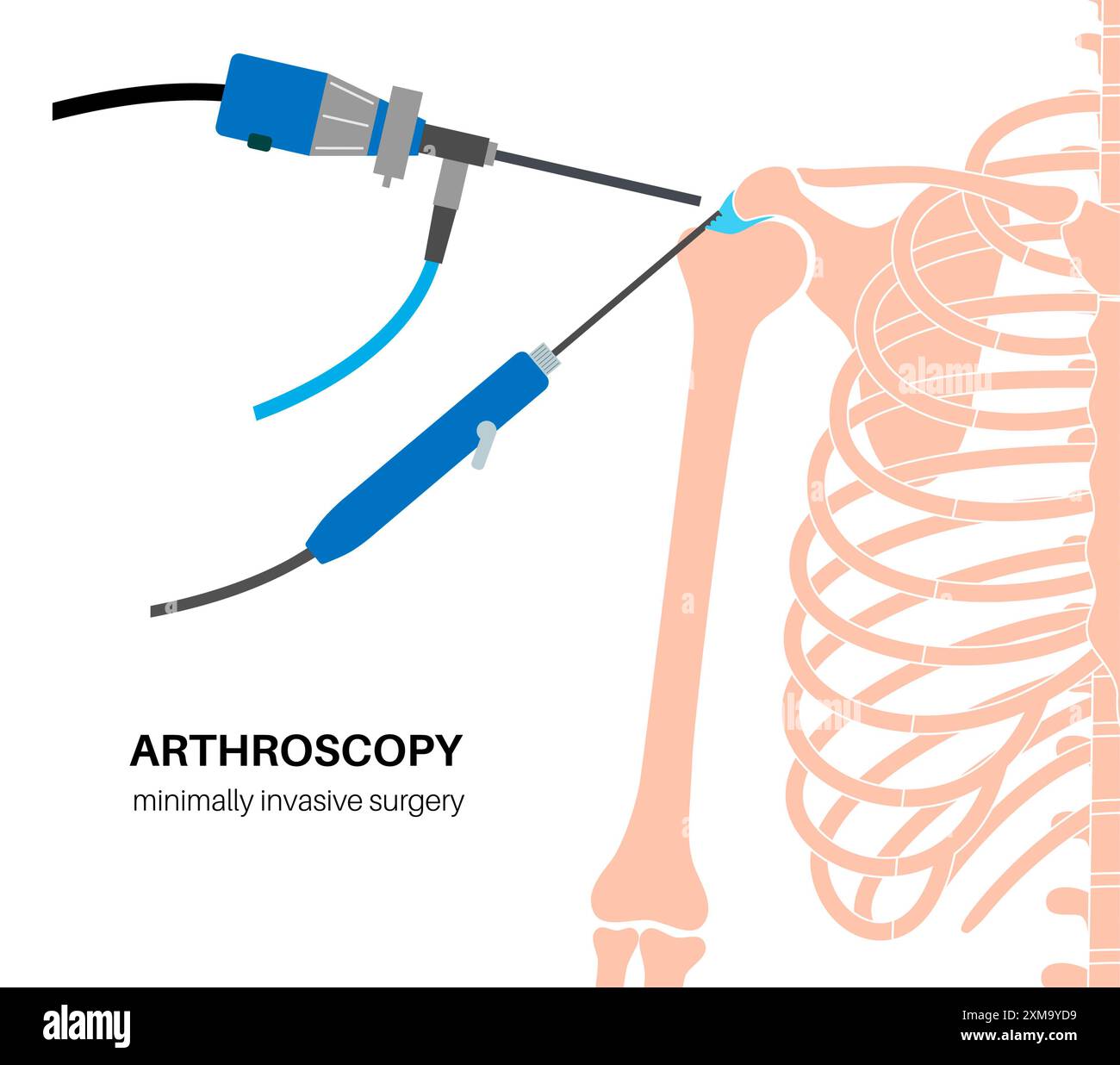 Illustration of a shoulder arthroscopy procedure. This is a procedure ...