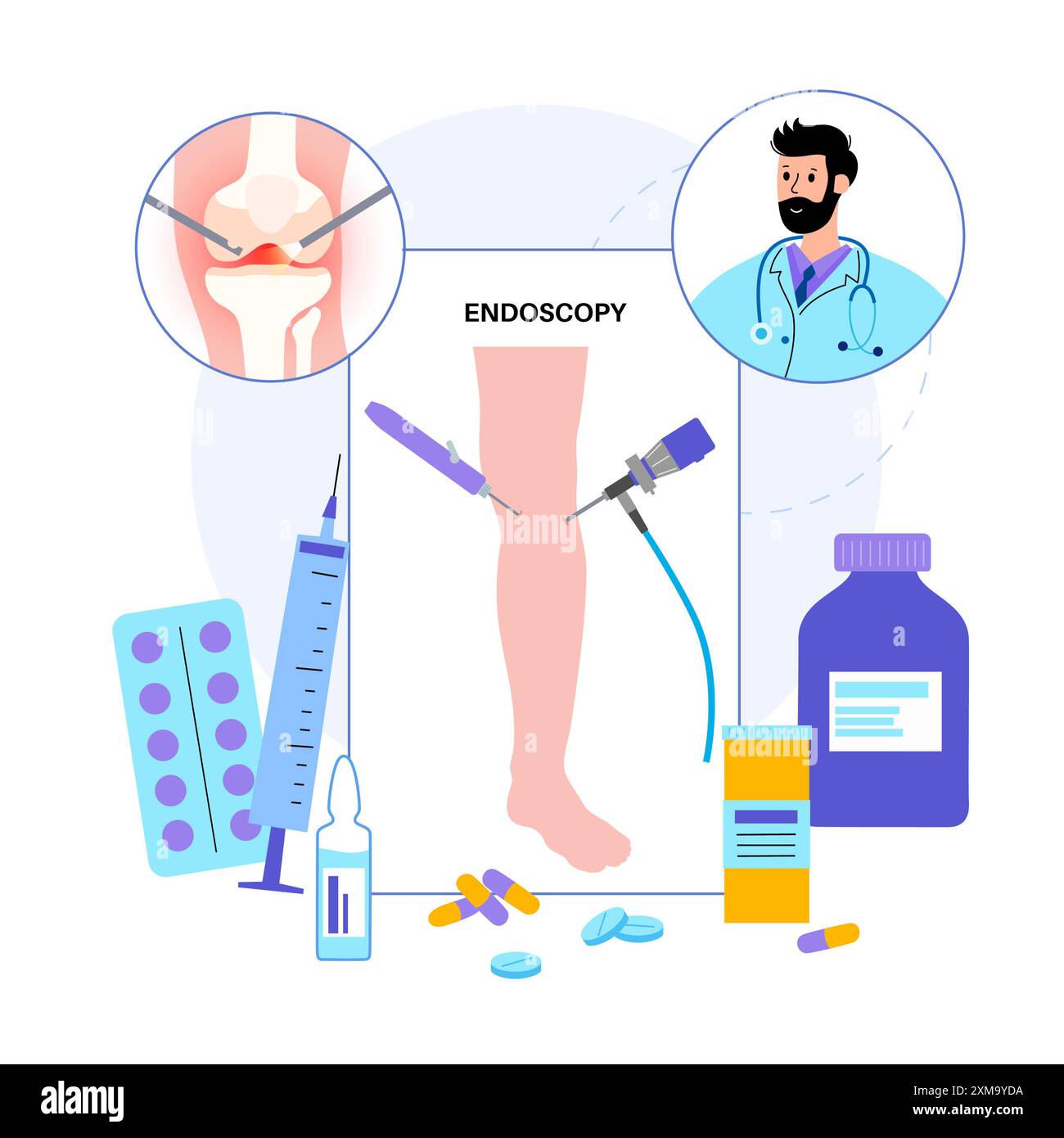 Illustration of knee joint arthroscopy procedure. This is a procedure ...