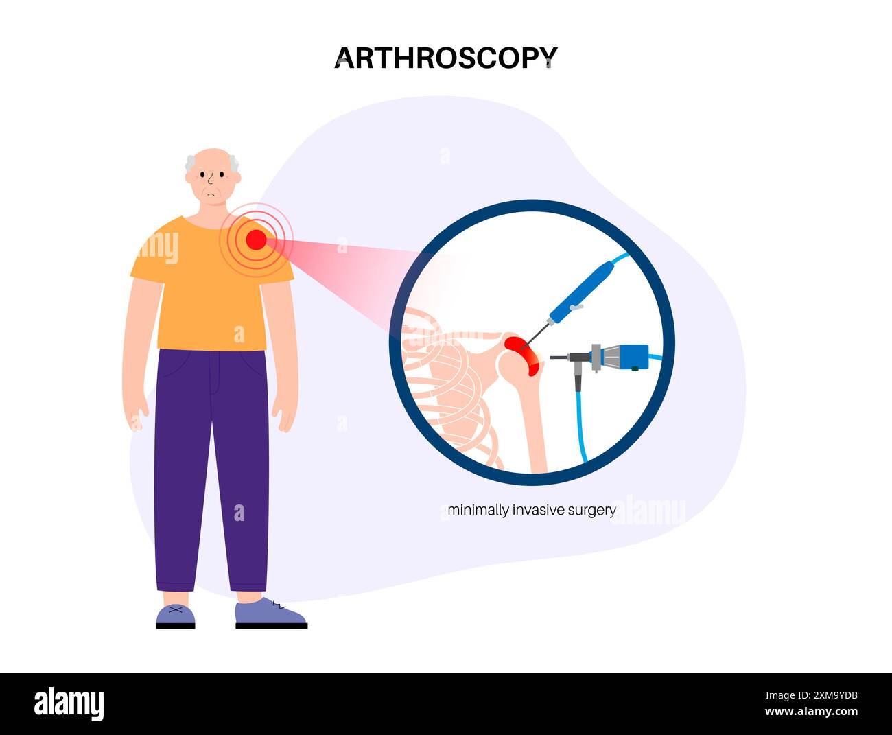 Shoulder arthroscopy procedure hi-res stock photography and images - Alamy