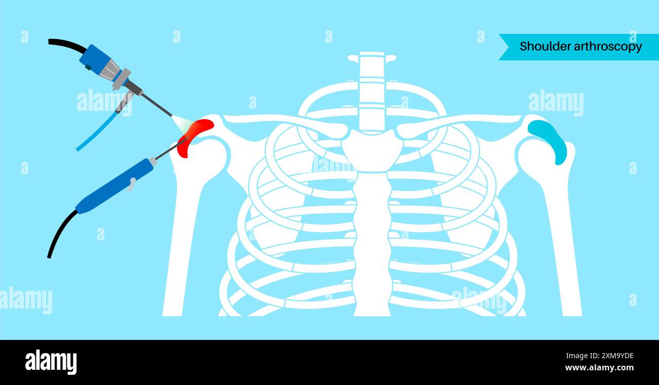 Illustration of a shoulder arthroscopy procedure. This is a procedure ...