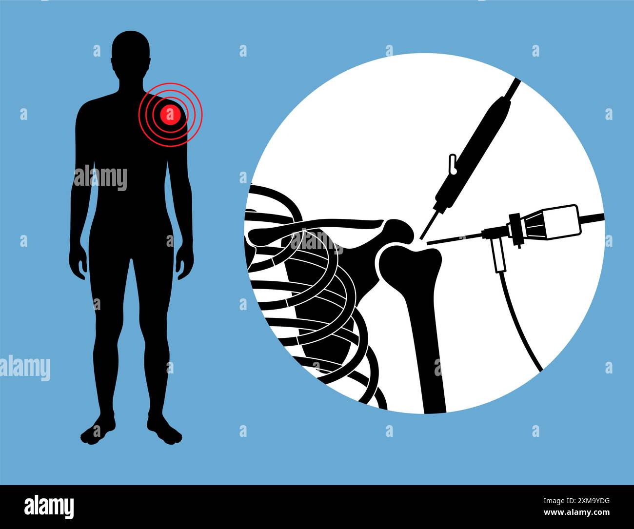 Shoulder arthroscopy procedure hi-res stock photography and images - Alamy