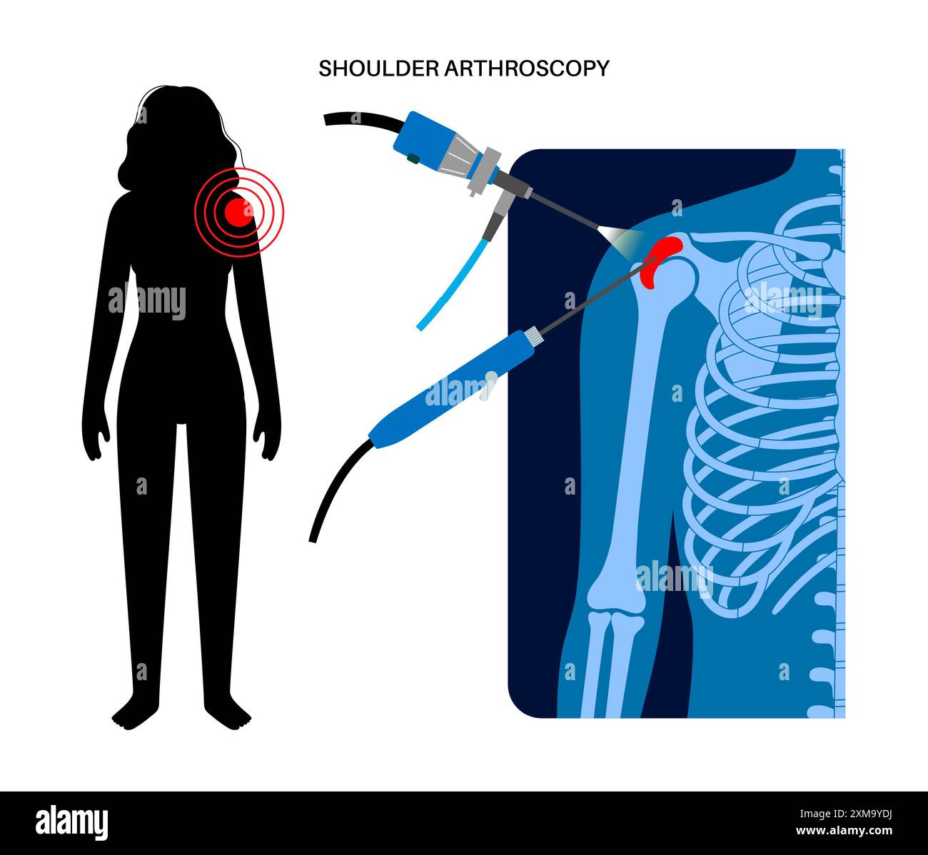 Illustration of a shoulder arthroscopy procedure. This is a procedure ...