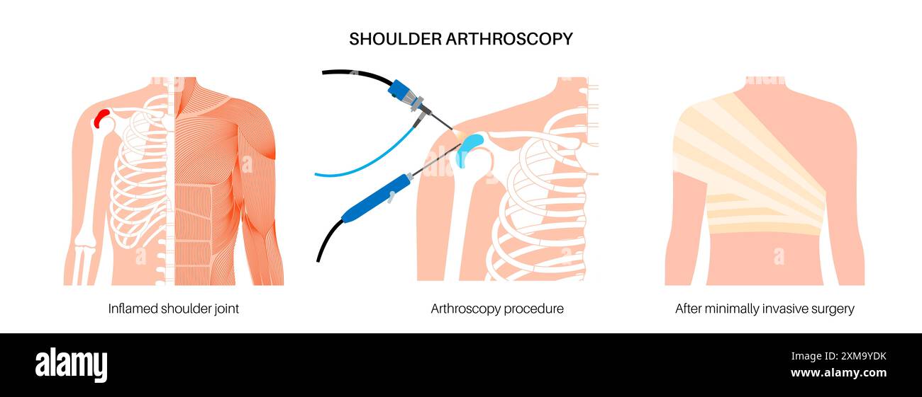 Shoulder arthroscopy procedure hi-res stock photography and images - Alamy