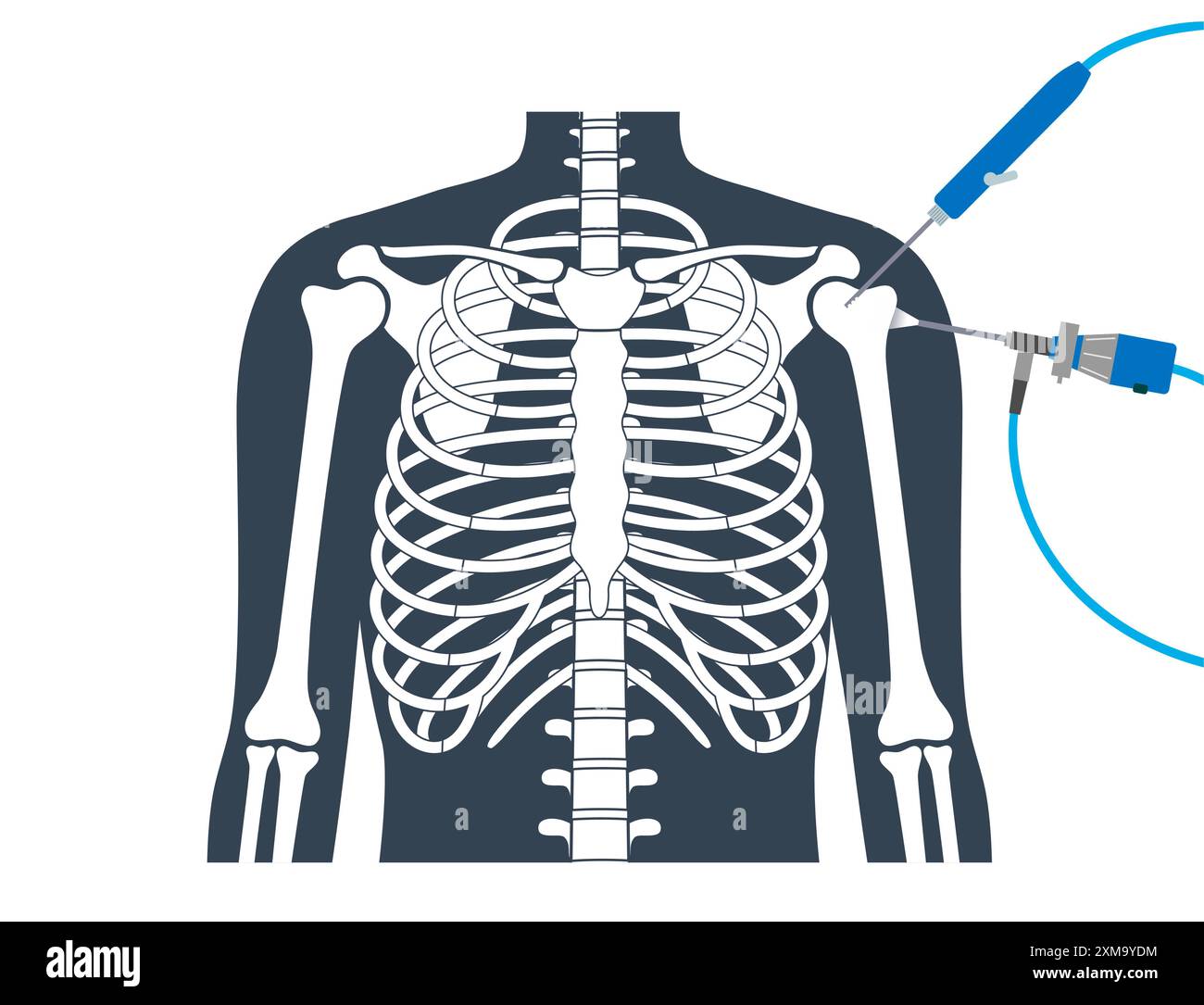 Shoulder arthroscopy procedure hi-res stock photography and images - Alamy