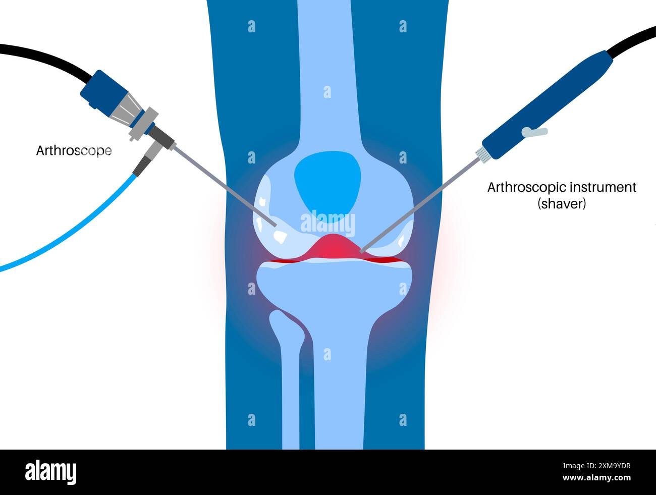 Illustration of knee joint arthroscopy procedure. This is a procedure ...