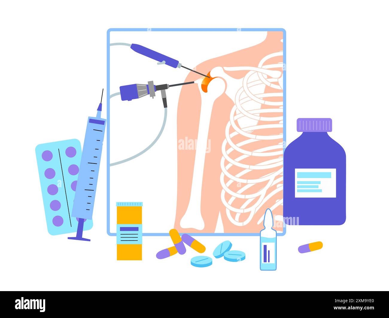 Shoulder arthroscopy procedure hi-res stock photography and images - Alamy