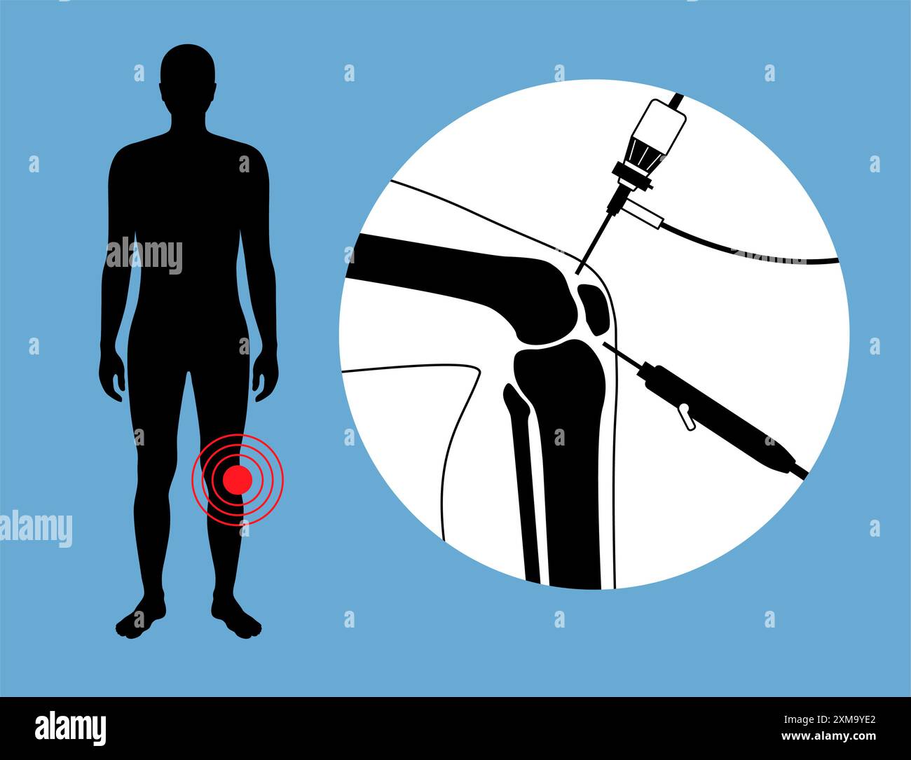 Illustration of knee joint arthroscopy procedure. This is a procedure ...