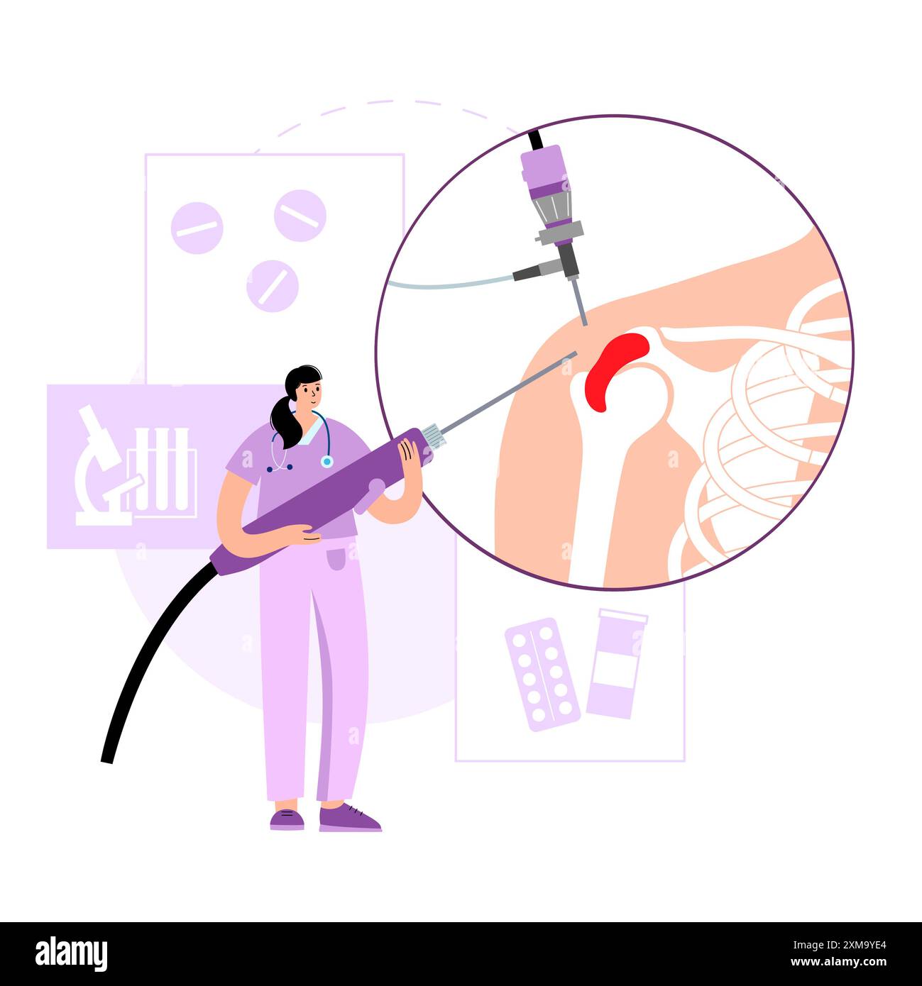 Illustration of a shoulder arthroscopy procedure. This is a procedure ...