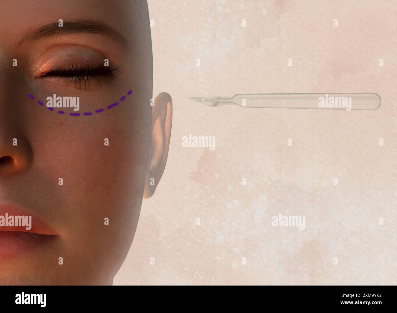 Eye surgery illustration hi-res stock photography and images - Alamy