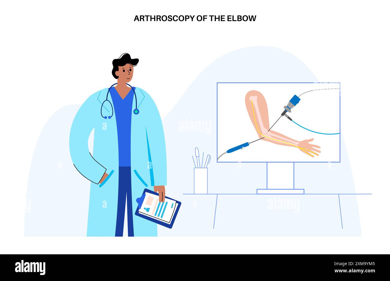 Illustration of elbow arthroscopy surgery. This is a procedure for ...