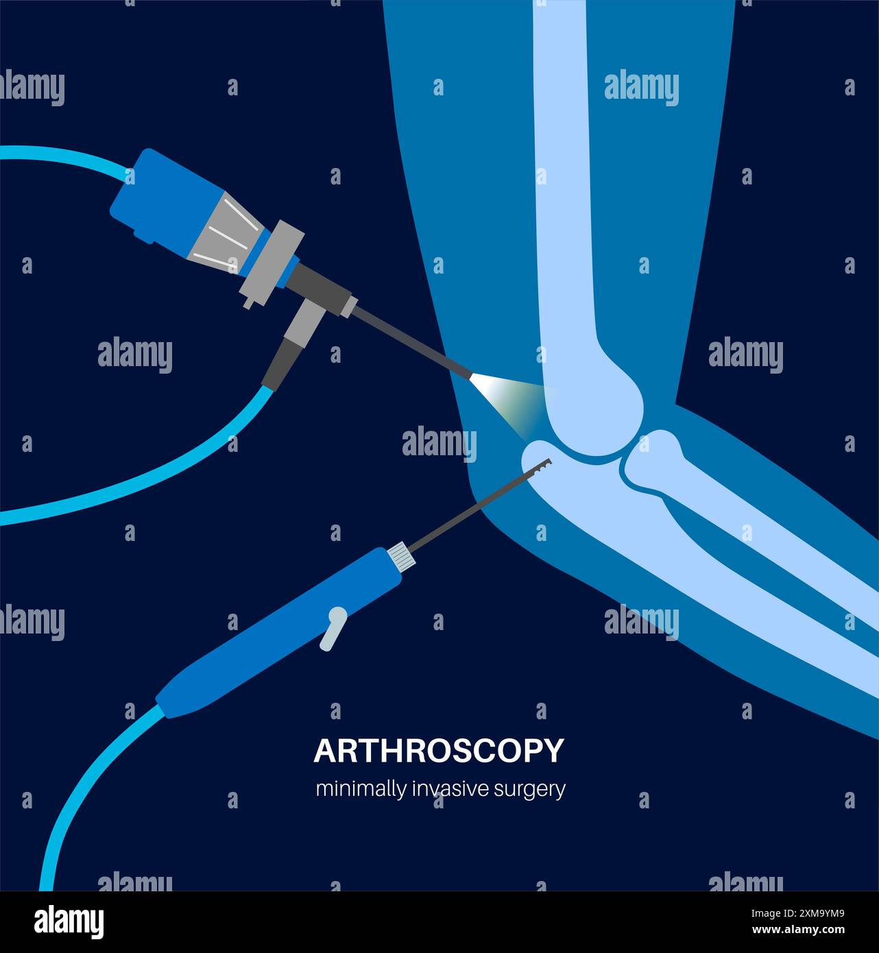 Illustration of elbow arthroscopy surgery. This is a procedure for ...