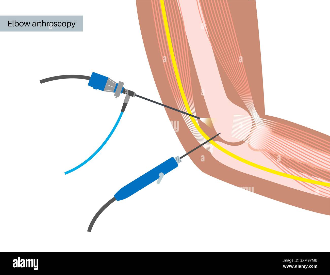 Illustration of elbow arthroscopy surgery. This is a procedure for ...