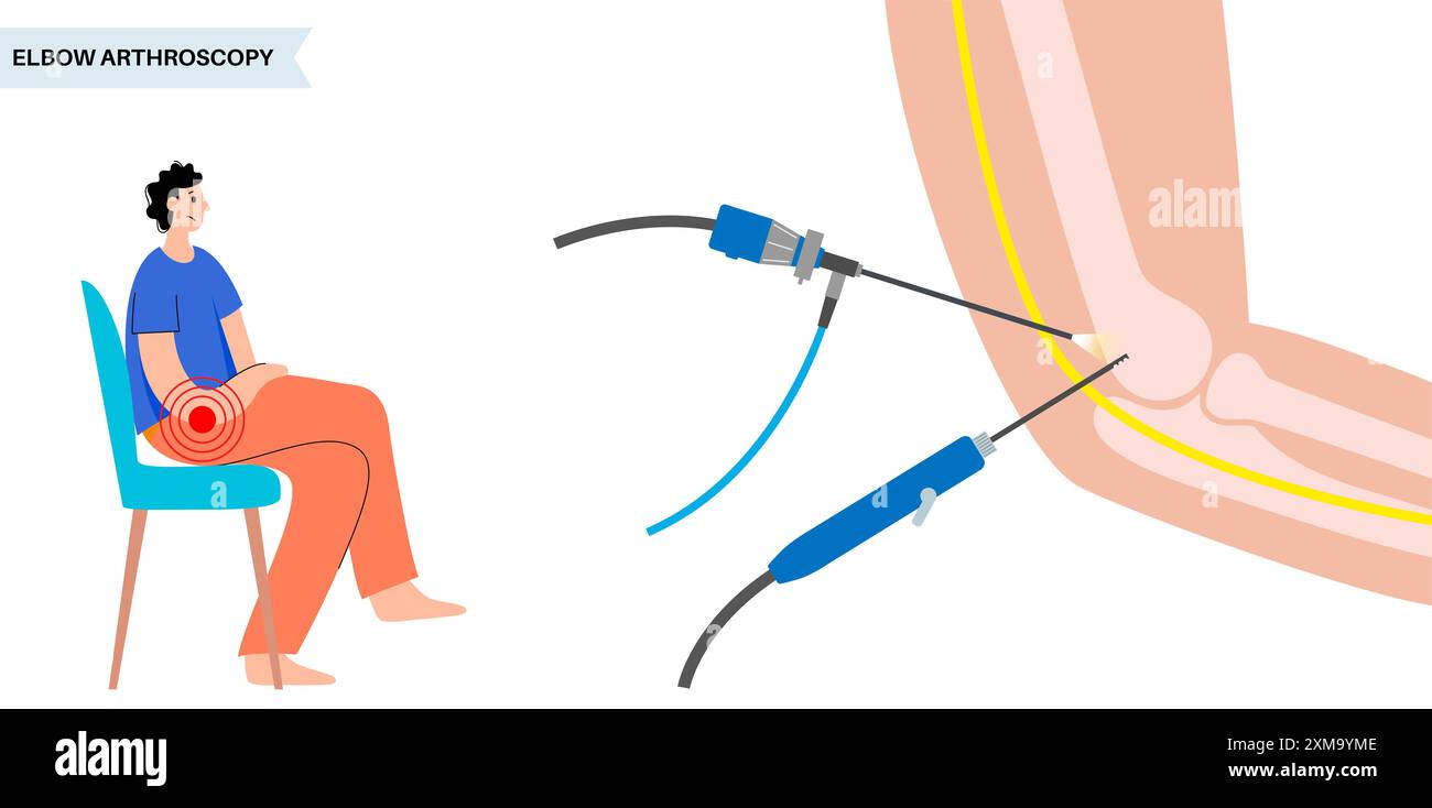 Illustration of elbow arthroscopy surgery. This is a procedure for ...
