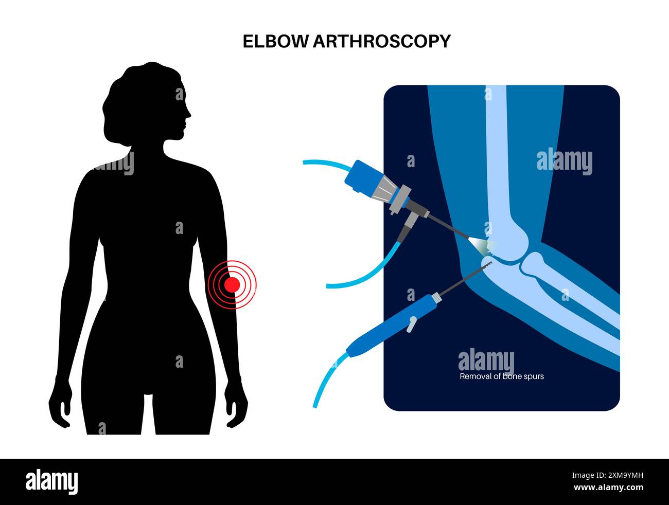 Elbow arthroscopy surgery hi-res stock photography and images - Alamy