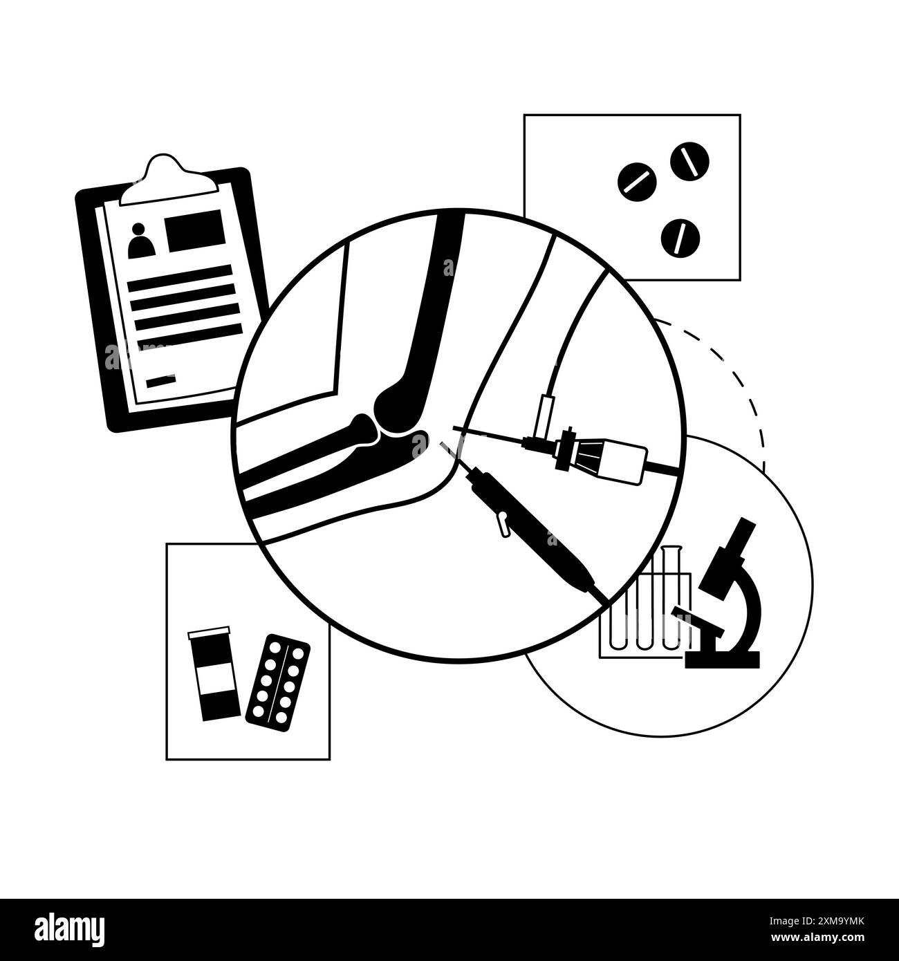 Illustration of elbow arthroscopy surgery. This is a procedure for ...